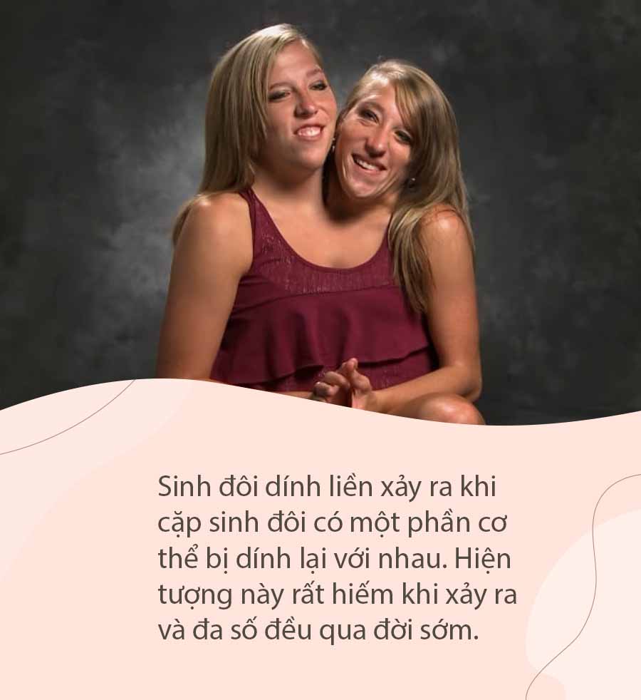 Bệnh lạ thế giới: Cặp song sinh dính liền lấy vợ, sinh 21 con