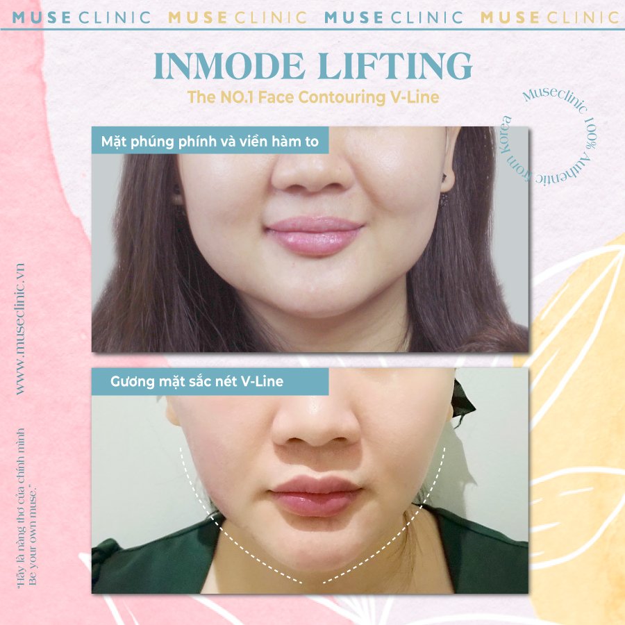 Công Nghệ InMode Lifting - Giải pháp tạo hình V-Line và thon gọn gương ...