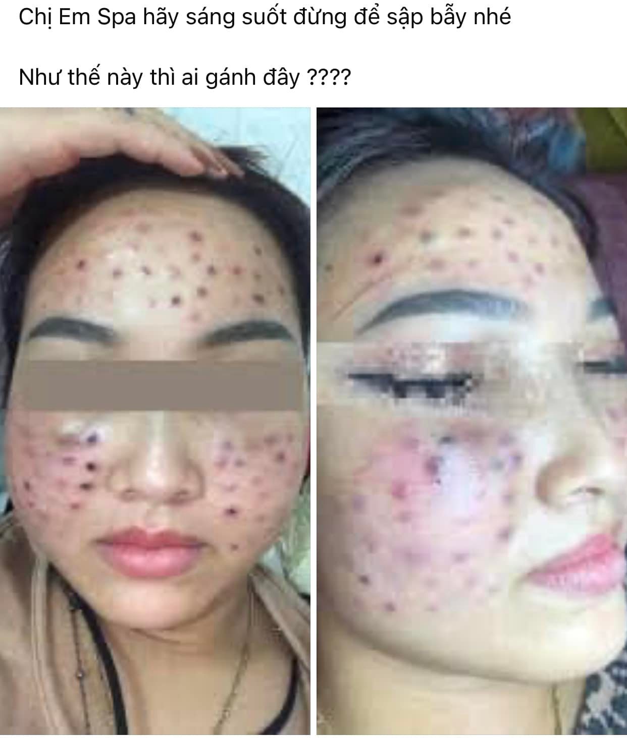 Tiêm meso cuối năm giá rẻ, cảnh báo tiêm meso giá rẻ