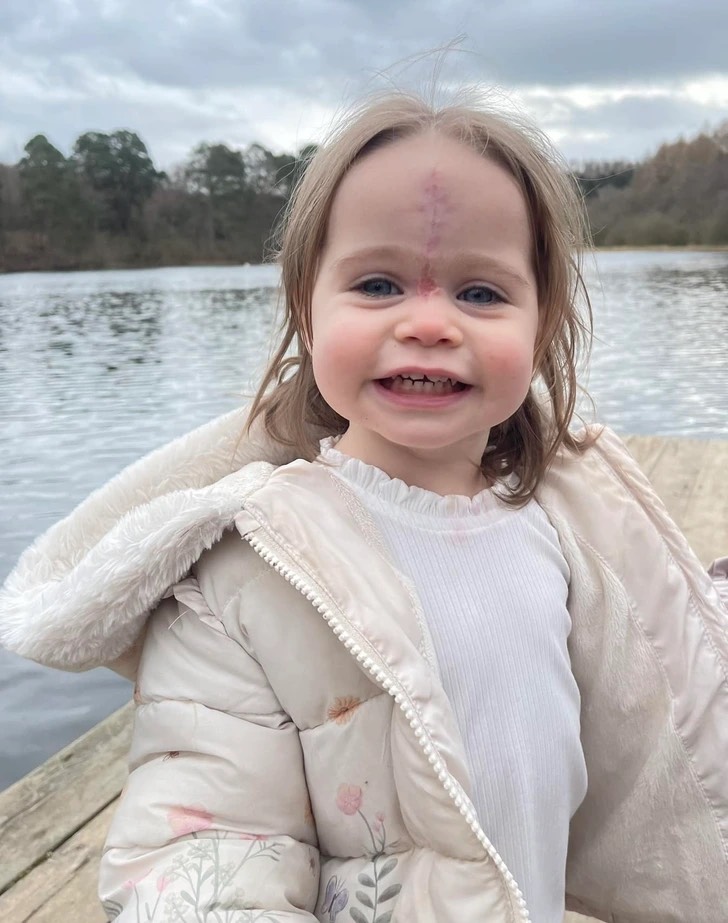 Bé gái có vết bớt hiếm gặp giữa trán, diện mạo hiện tại bất ngờ