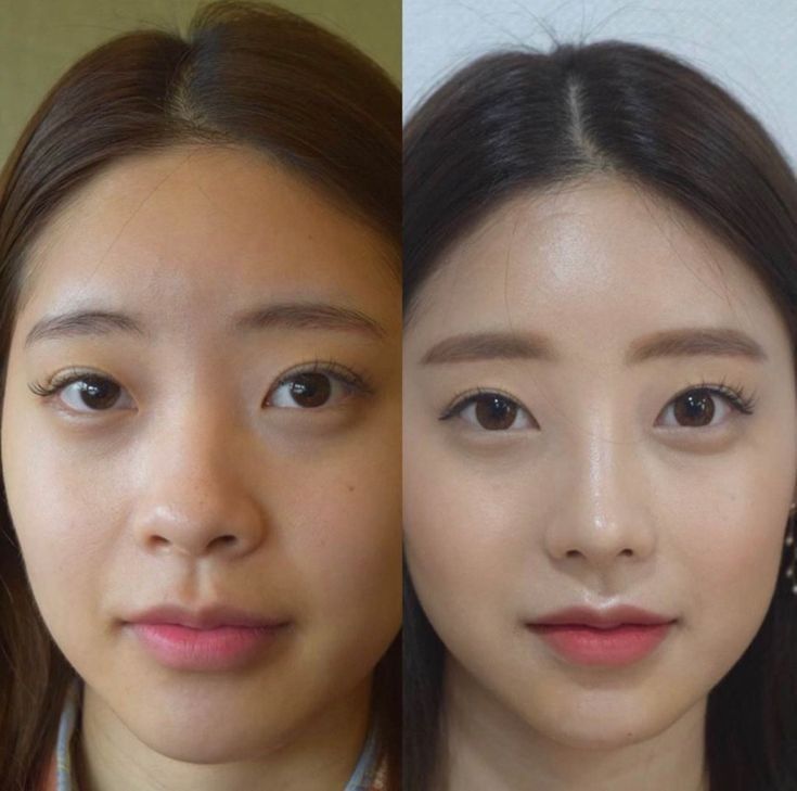 Những dấu hiệu bạn đang bị biến chứng sau khi làm mũi