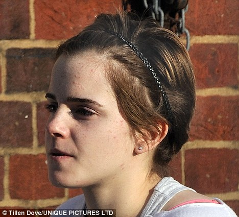emma watson pimples