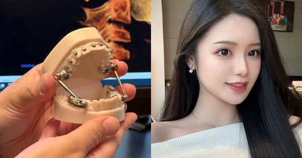 Chỉnh nha kiểu Meaw - Geaw: Vì sao được giới trẻ săn đón?